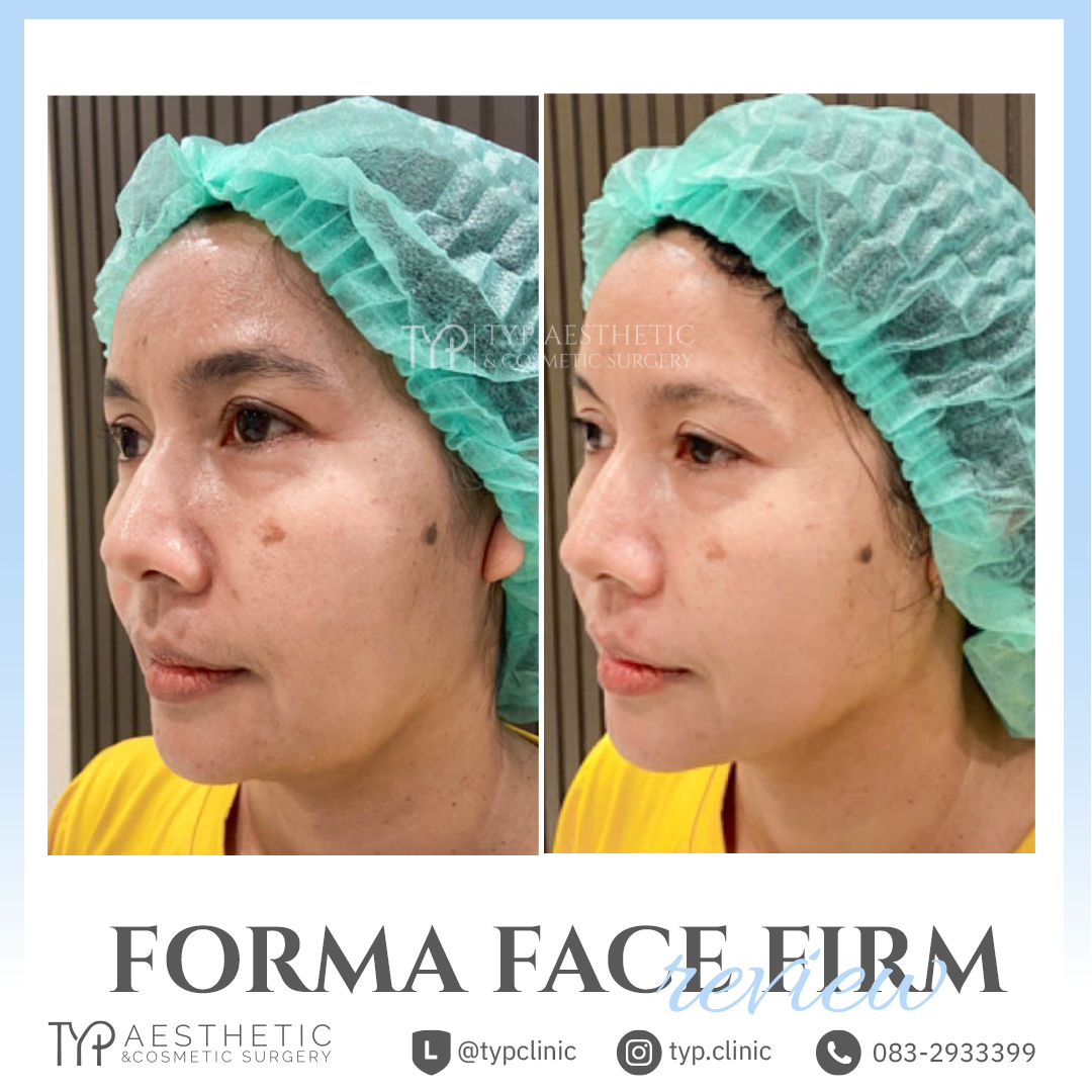 Forma face firm - TYP Hospital